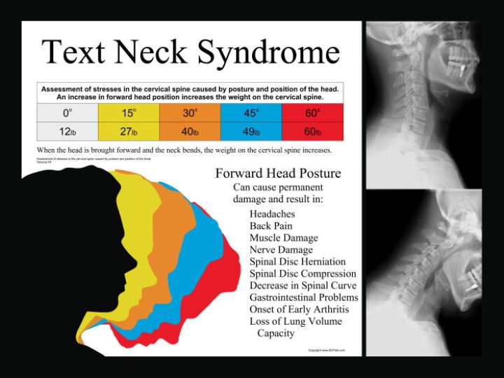 Text Neck Syndrome - The Spine Center